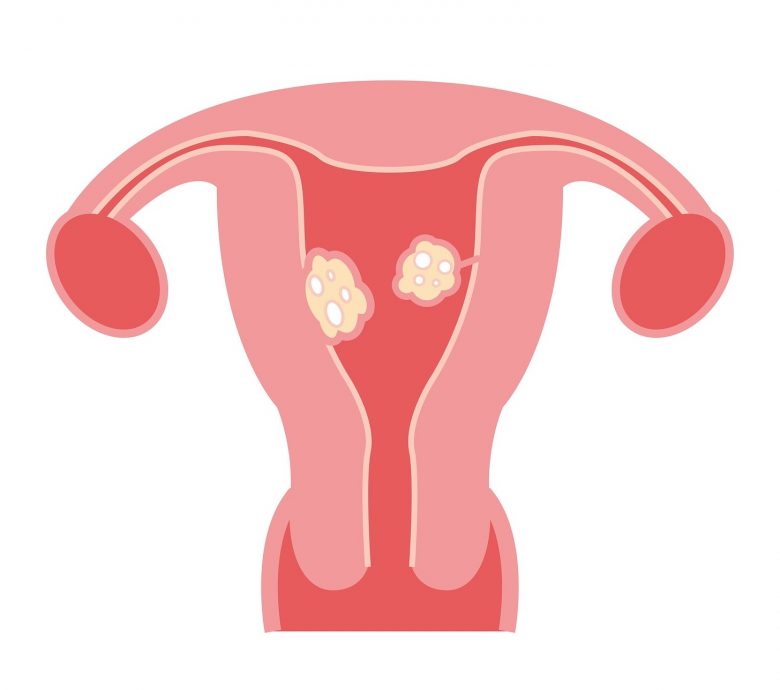 Penyakit Fibroid - Punca, Tanda dan Rawatan - Tips Kesihatan
