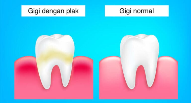 Karang Gigi - Punca, Rawatan dan Pencegahan - Tips Kesihatan